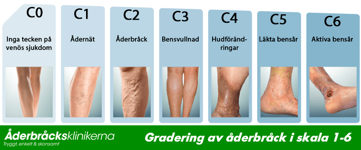 Ta bort åderbråck | Olika behandlingsmetoder